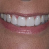 Veneers: Dr. Steven M O'Neal DDS